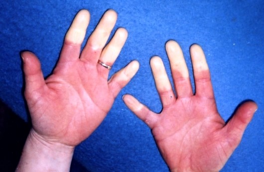 Raynaud’s Disease Treatment | PhysioMax Wellness - Burlington